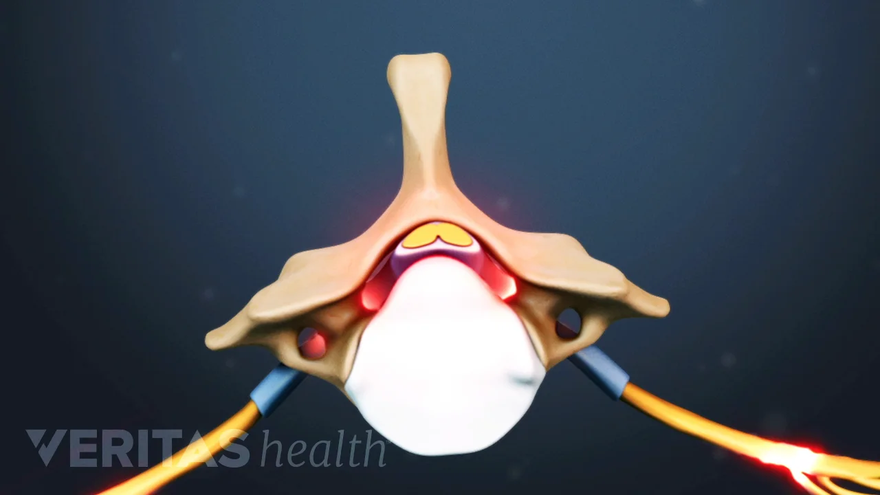 Treatment Options for Synovial Cysts | Spine-health