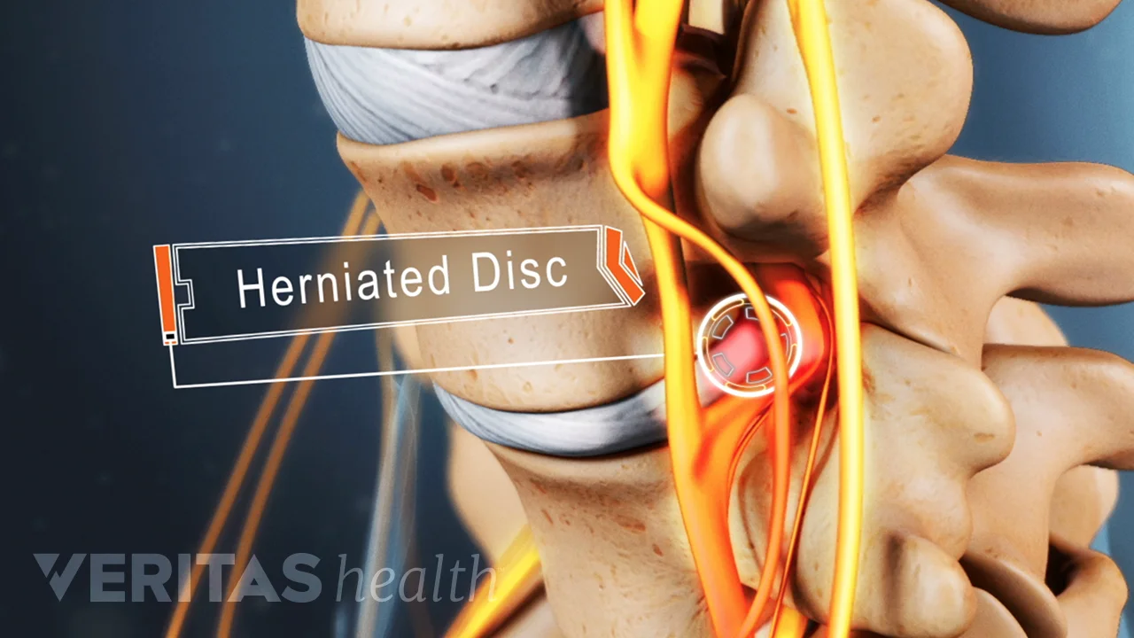 Exercise for Sciatica from a Herniated Disc | Spine-health