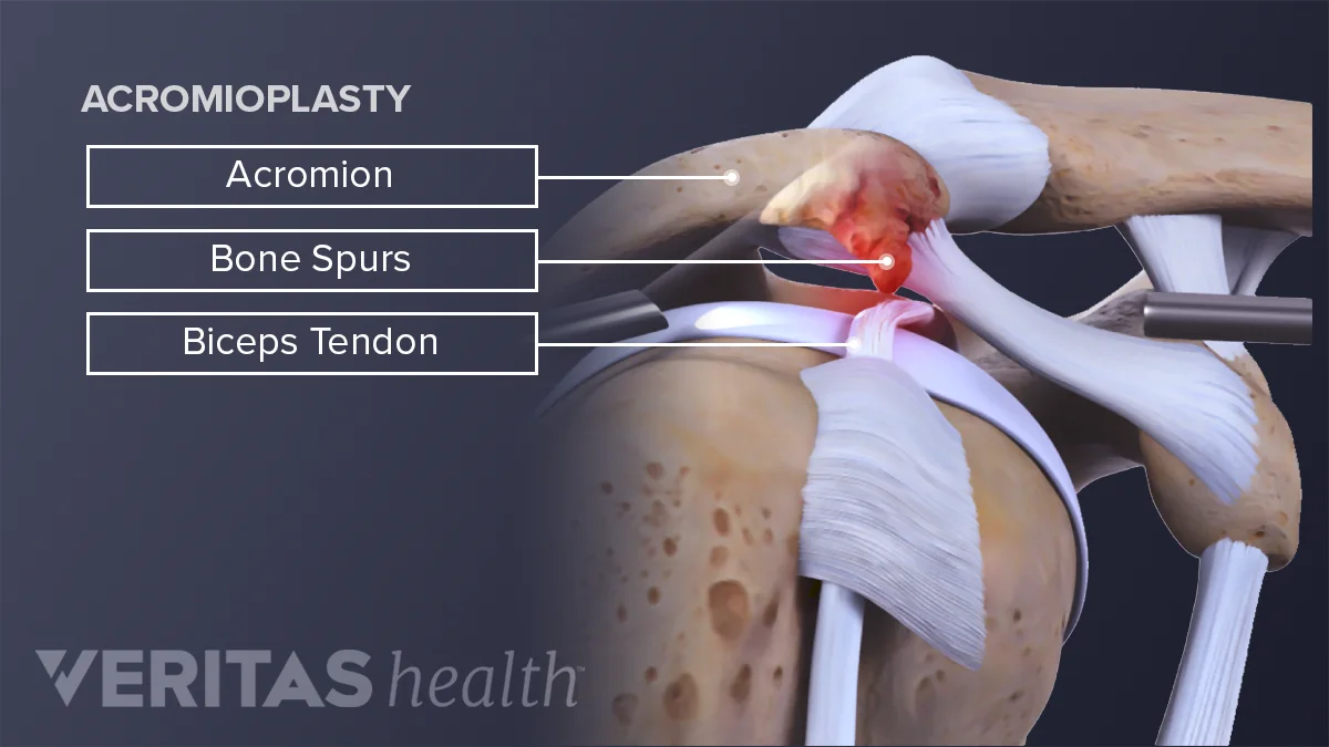 Shoulder Bursitis Surgery | Arthritis-health