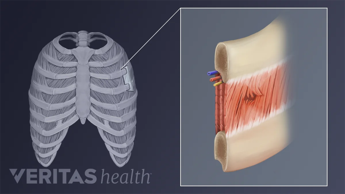 Causes of Intercostal Muscle Strain | Spine-health
