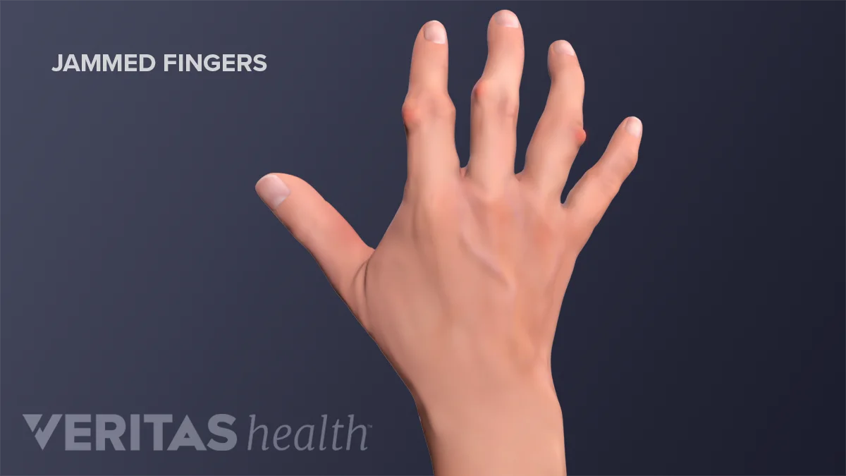 Treating a Jammed Finger | Sports-health