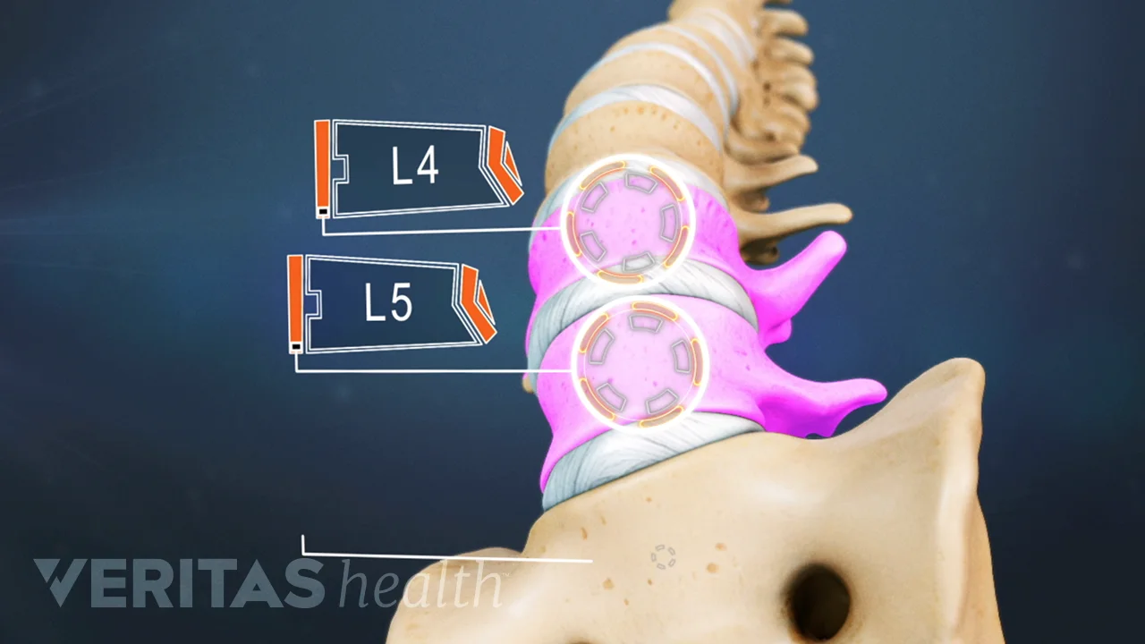L4-L5 Treatment | Spine-health