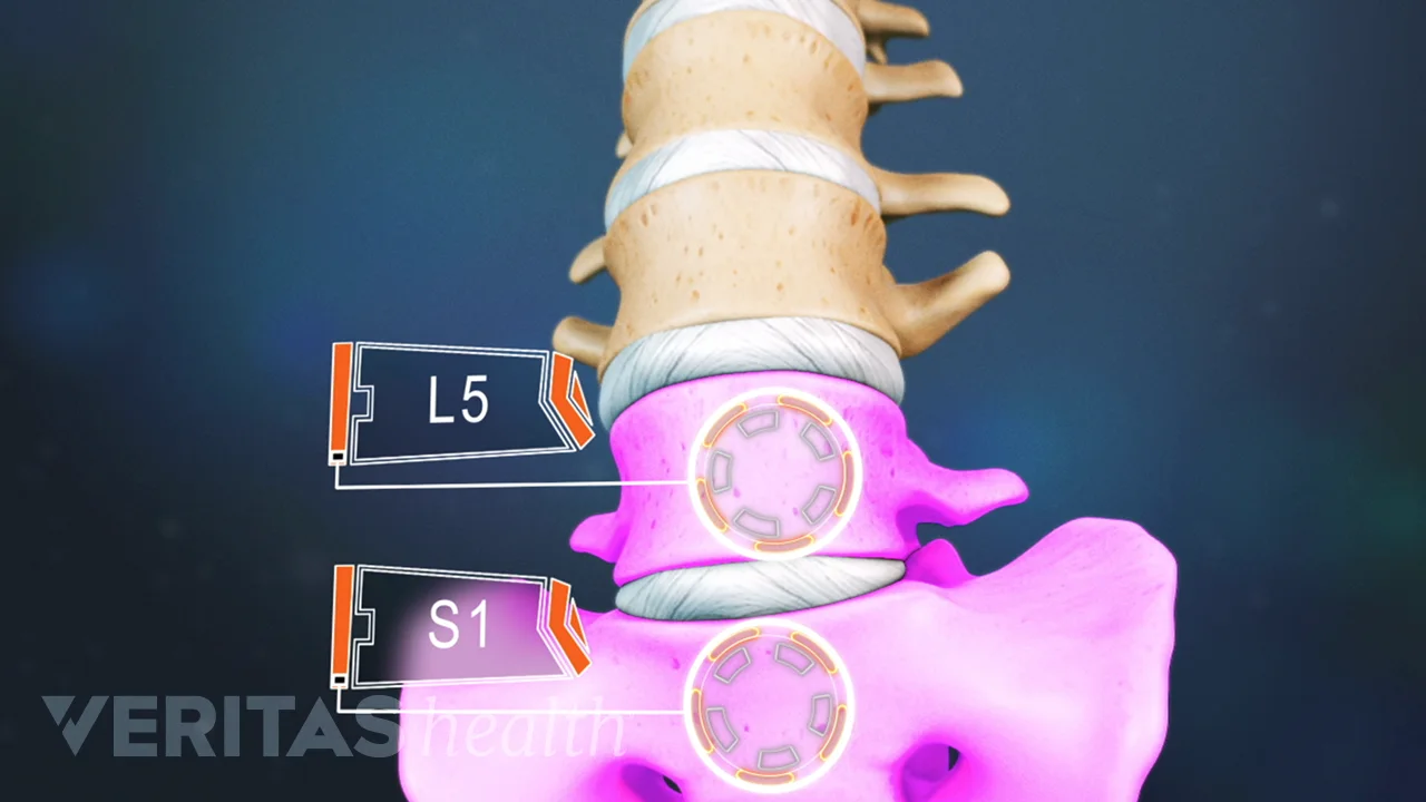 L5-S1 Treatment | Spine-health