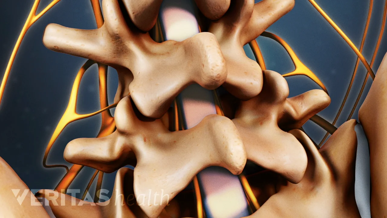 How Microdiscectomy Surgery Is Performed | Spine-health