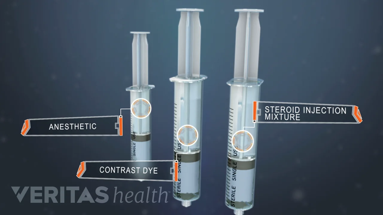 How Epidural Steroid Injections Work | Spine-health