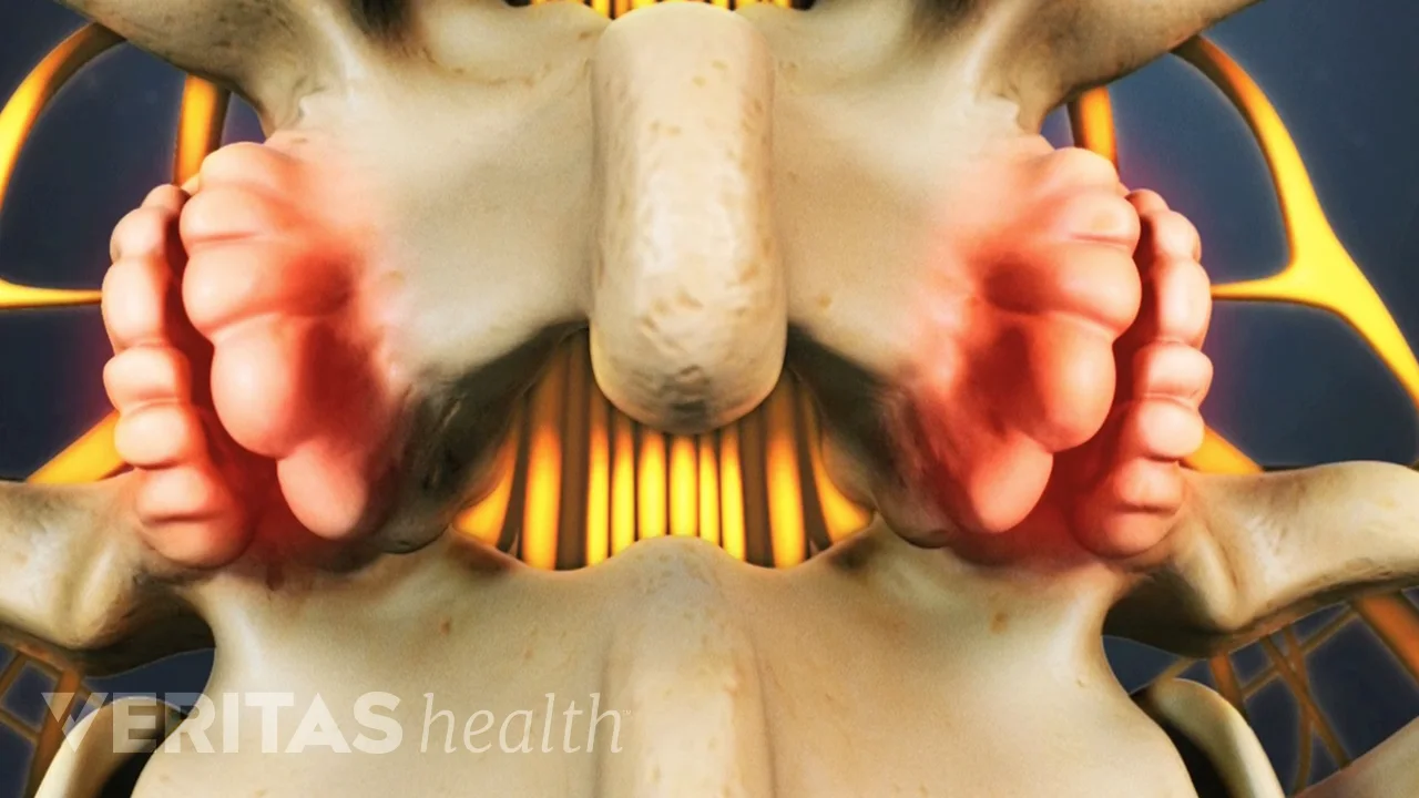 Lumbar Osteophytes (Bone Spurs) Video | Spine-health