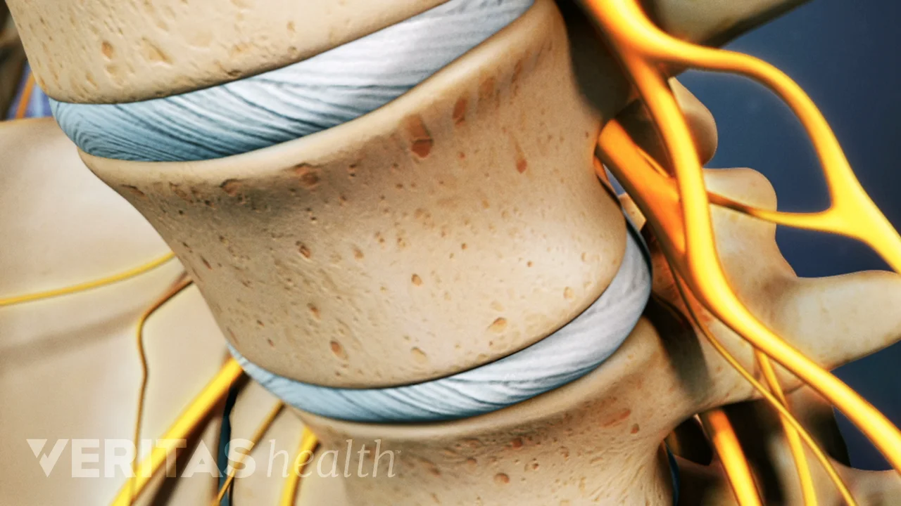 Lumbar Discography for Back Pain Diagnosis | Spine-health