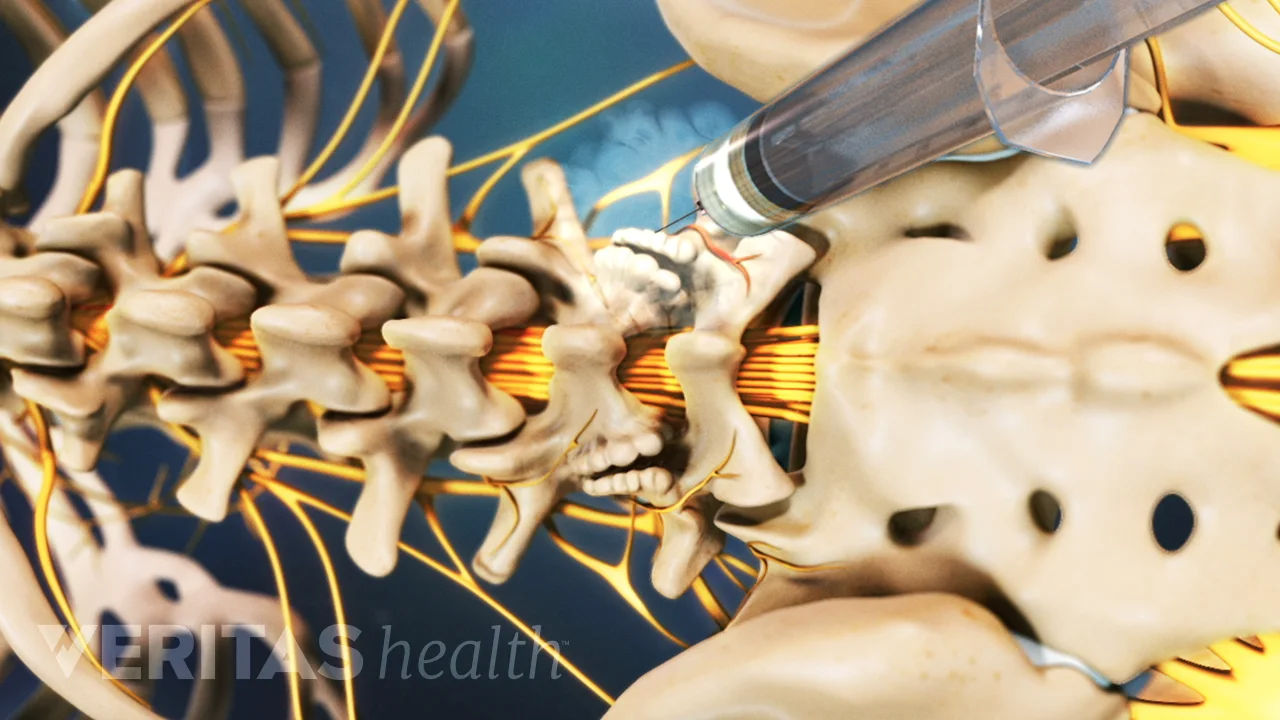 Facet Joint Injection Procedure | Spine-health