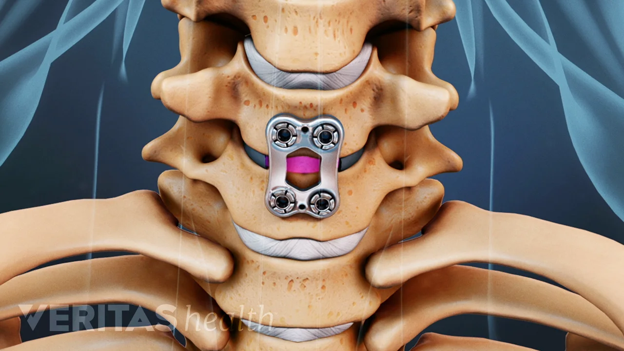 Cervical Foraminal Stenosis Surgery | Spine-health