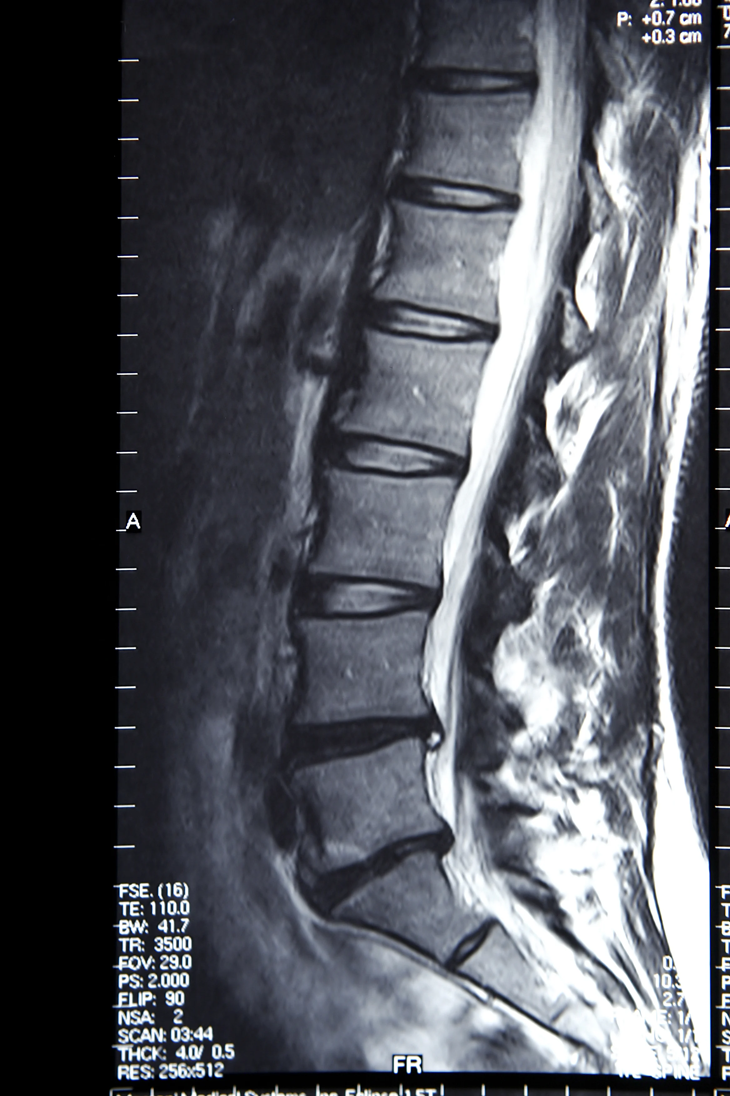 Indications and Contraindications for an MRI Scan | Spine-health