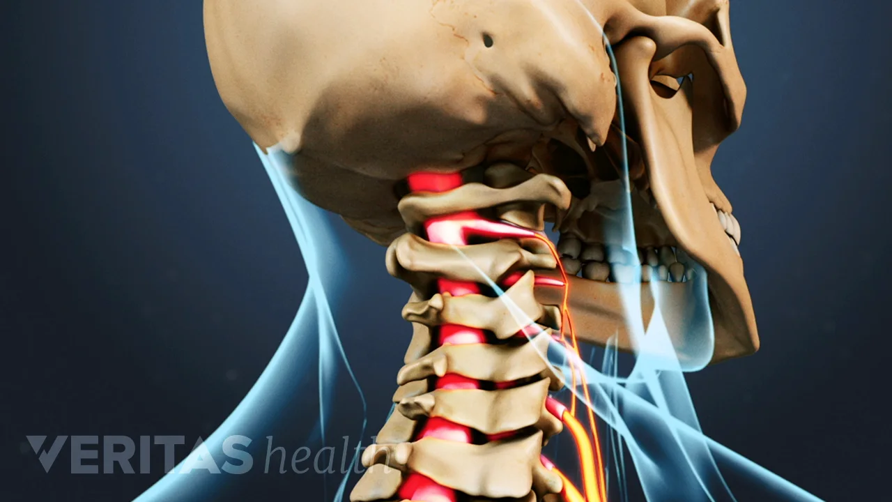 How Cervical Radiculopathy Causes Pain, Numbness, and Weakness | Spine ...