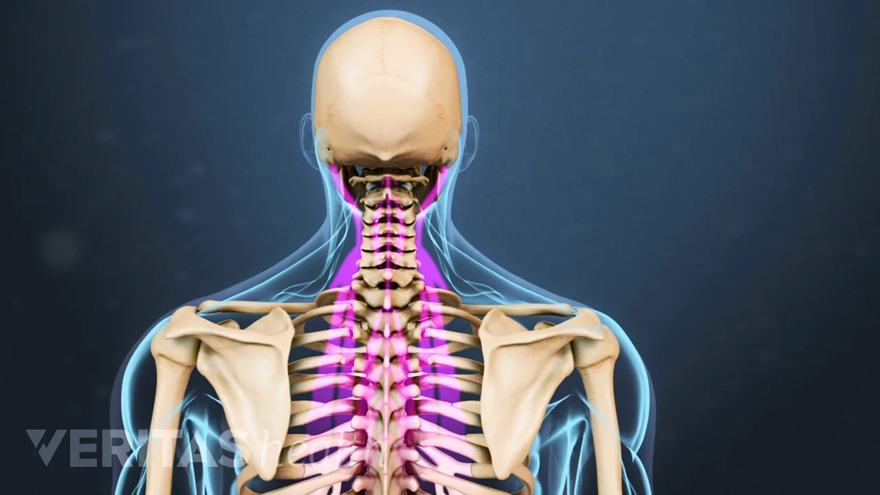 How Neck Bones and Soft Tissues React to Spinal Degeneration | Spine-health