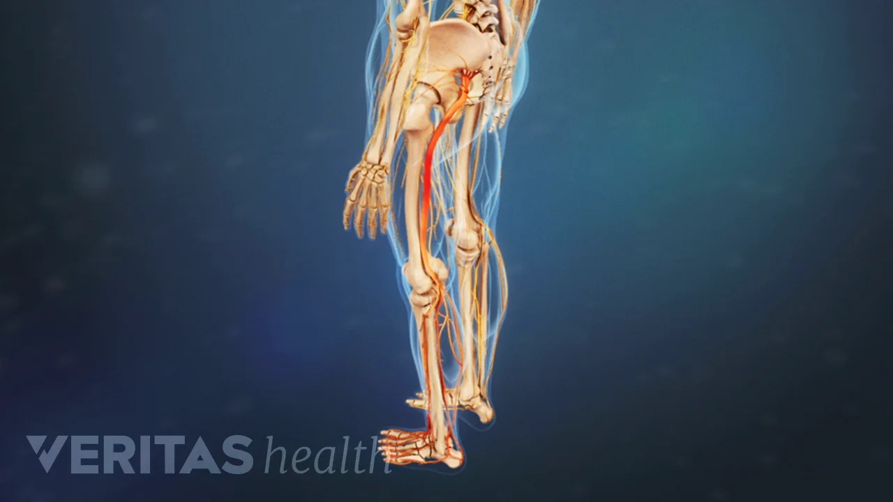 What Is Foot Drop? | Spine-health