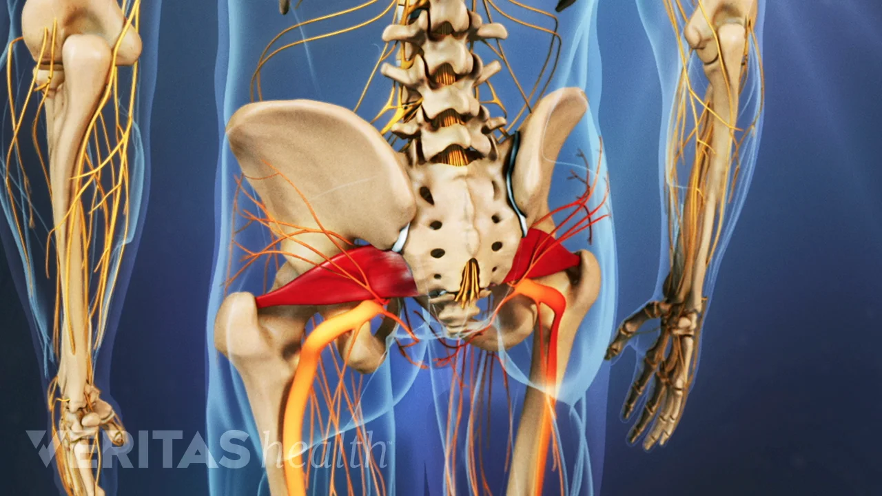 Video sobre síndrome piriforme | Spine-health