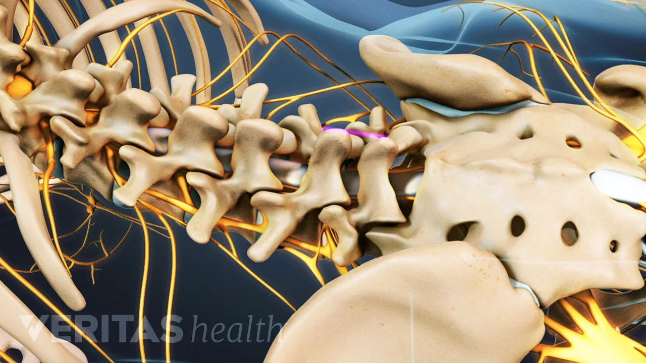 Allograft: Bone Graft from a Donor | Spine-health