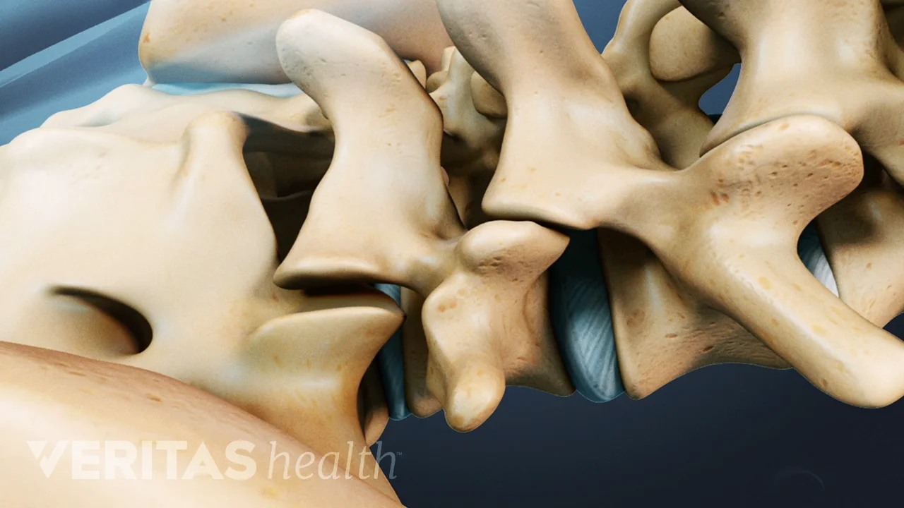 Lumbar Artificial Disc Replacement for Chronic Back Pain | Spine-health