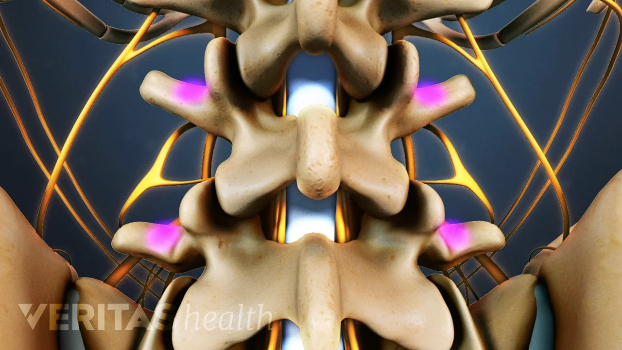 Posterolateral Gutter Spine Fusion Surgery | Spine-health