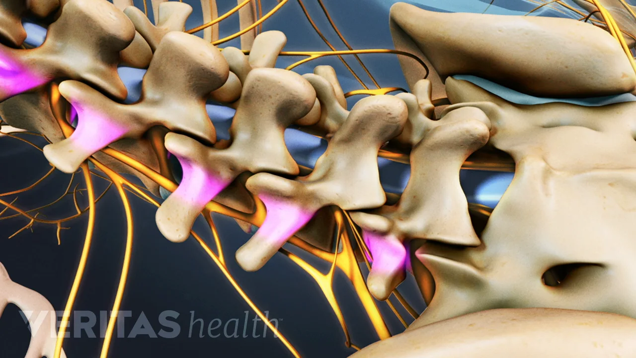 External Bone Growth Stimulators for Spine Fusion | Spine-health