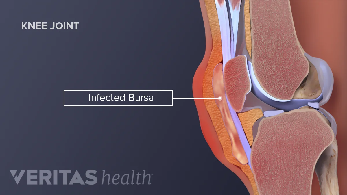 Septic Bursitis: The Serious Side of Bursitis | Arthritis-health