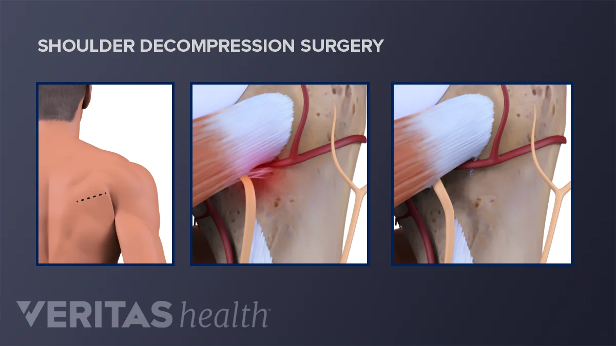 Shoulder Decompression Surgery: Recovery, Risks, and Complications ...