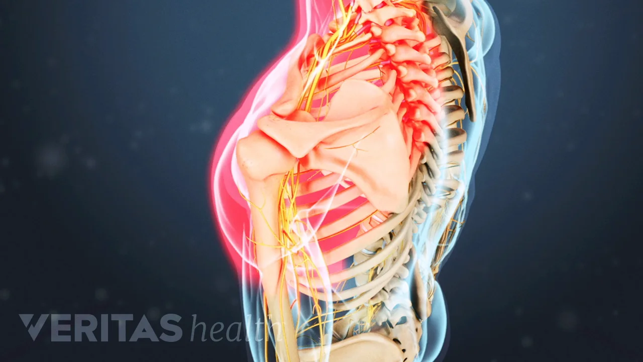 Cervical Herniated Disc Signs and Symptoms | Spine-health