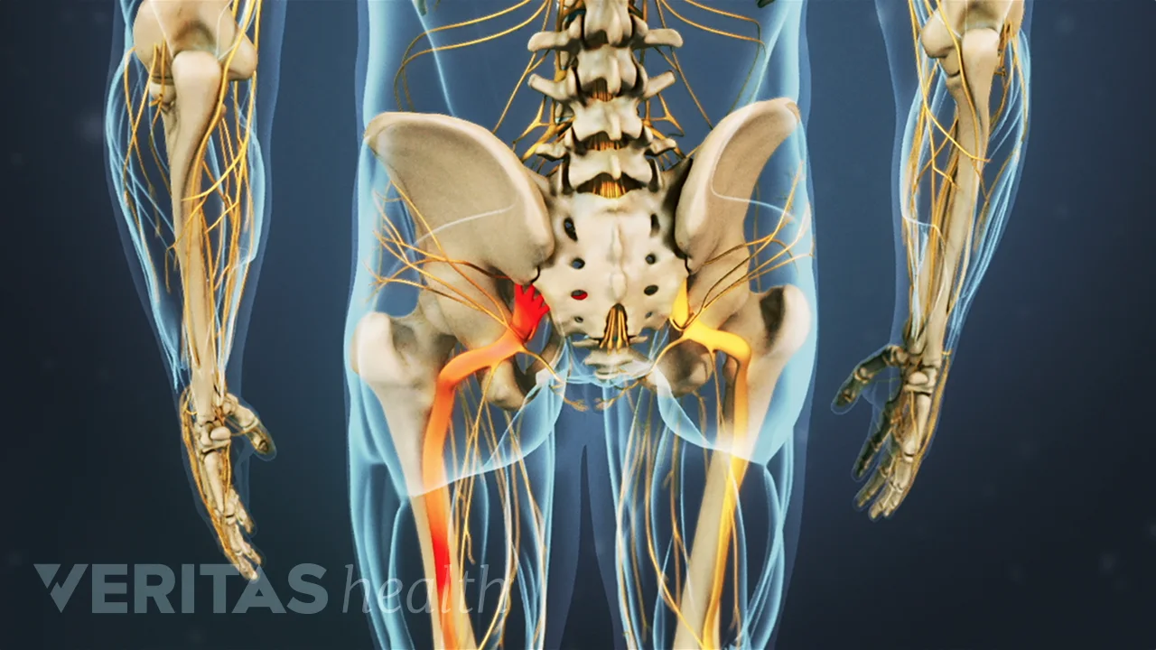 Types of Sciatic Nerve Pain | Spine-health