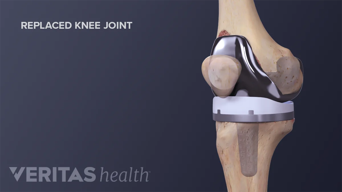 Double Knee Replacements | Arthritis-health