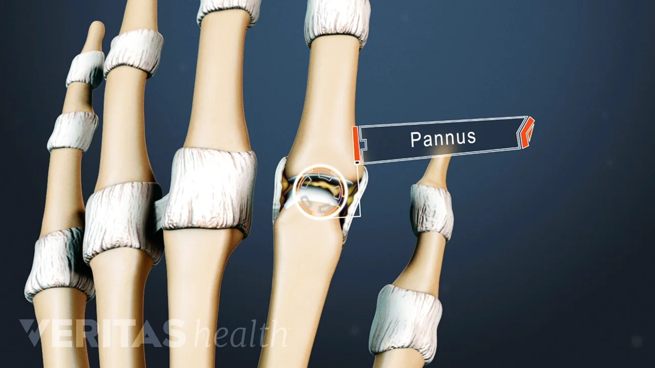 How to Treat Rheumatoid Pannus | Arthritis-health