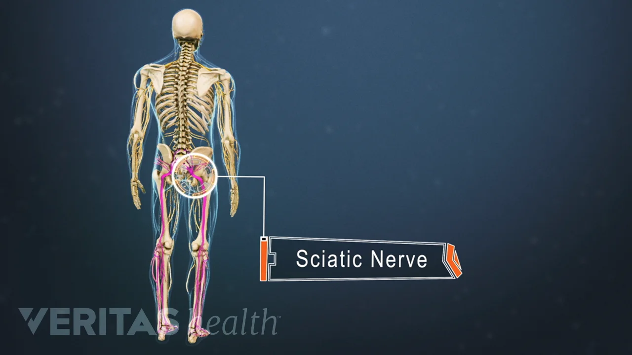 How to Apply Heat Therapy for Your Sciatica Symptoms | Spine-health