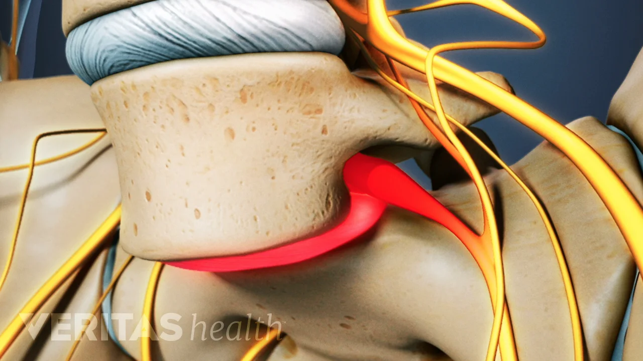 Spondylolysis and Spondylolisthesis | Spine-health