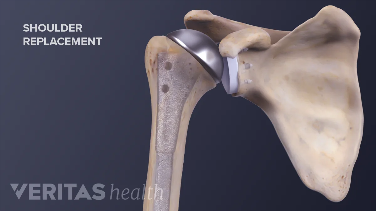 Surgery for Shoulder Osteoarthritis | Arthritis-health