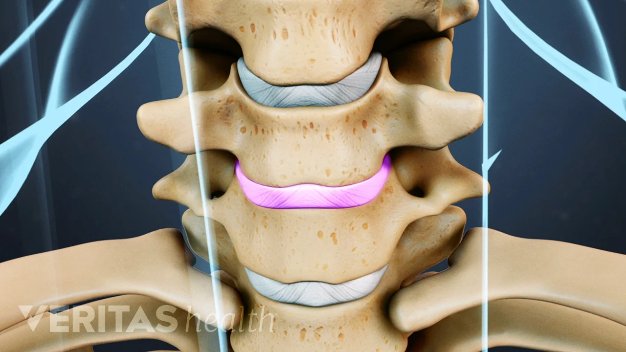 Neck Mobility After a Single-Level Cervical Fusion | Spine-health