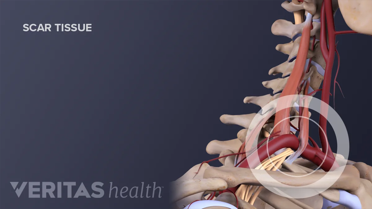 How the Graston Technique Works | Spine-health
