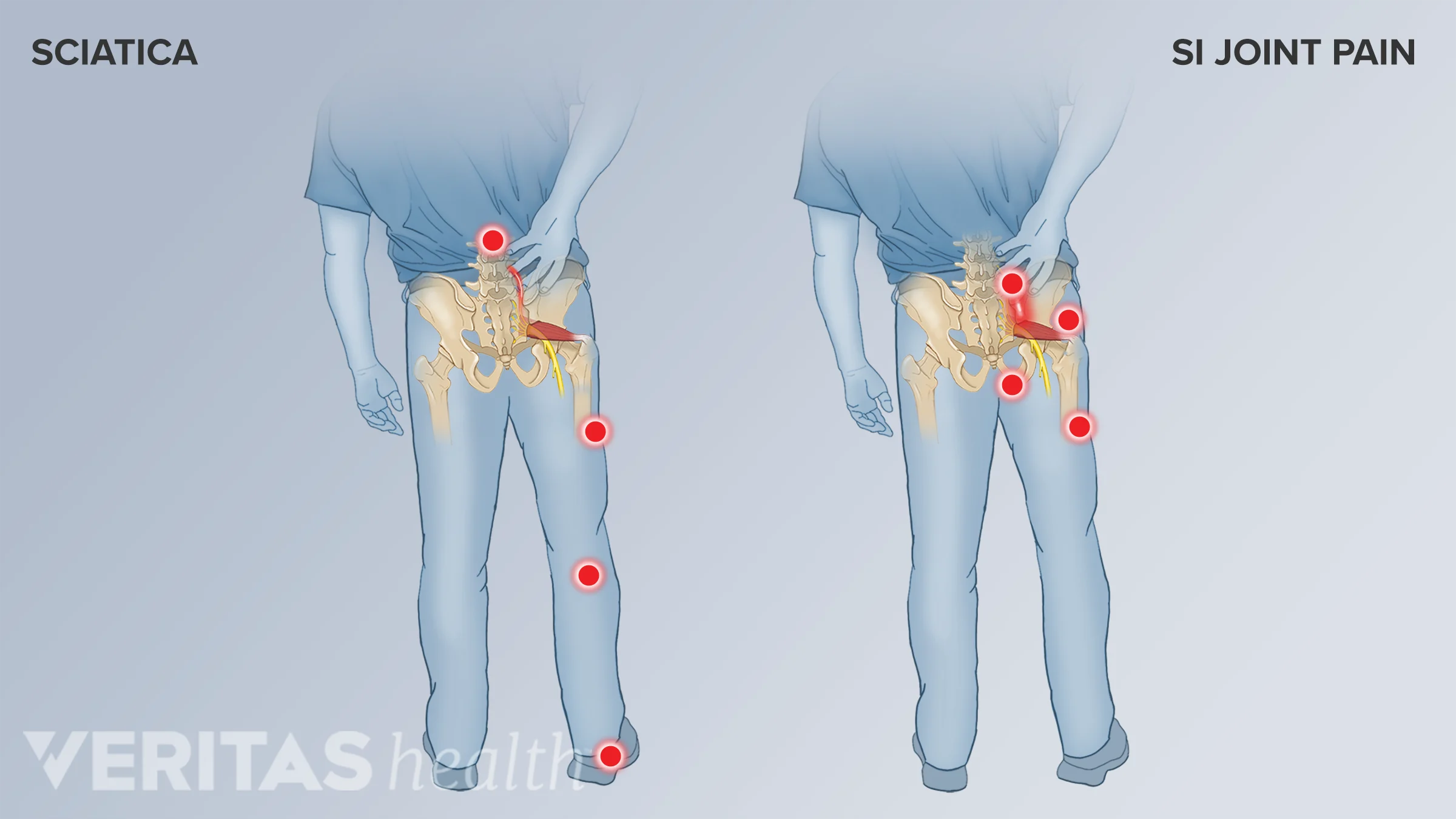 Is Sacroiliitis the Same Thing as Sciatica? | Spine-health