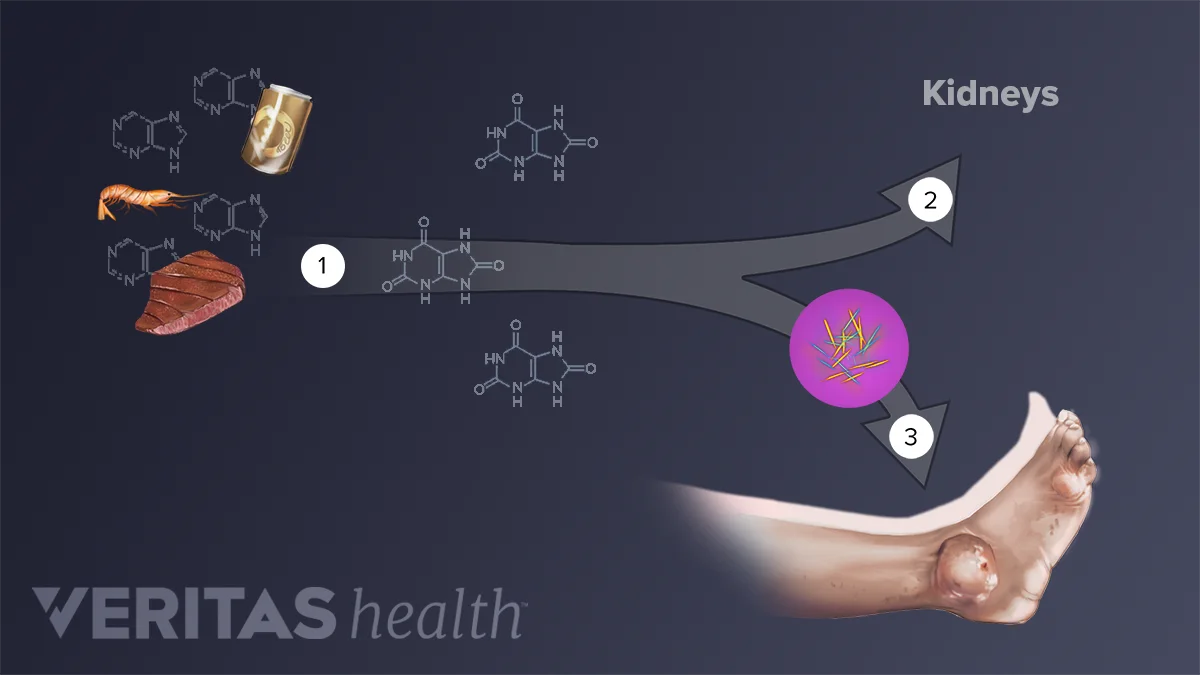 What Are Purines? | Arthritis-health