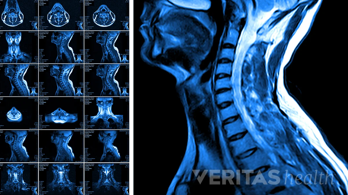 Klippel-Feil Syndrome Diagnosis | Spine-health