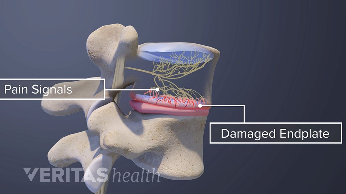 Treatment for Vertebrogenic Back Pain | Spine-health