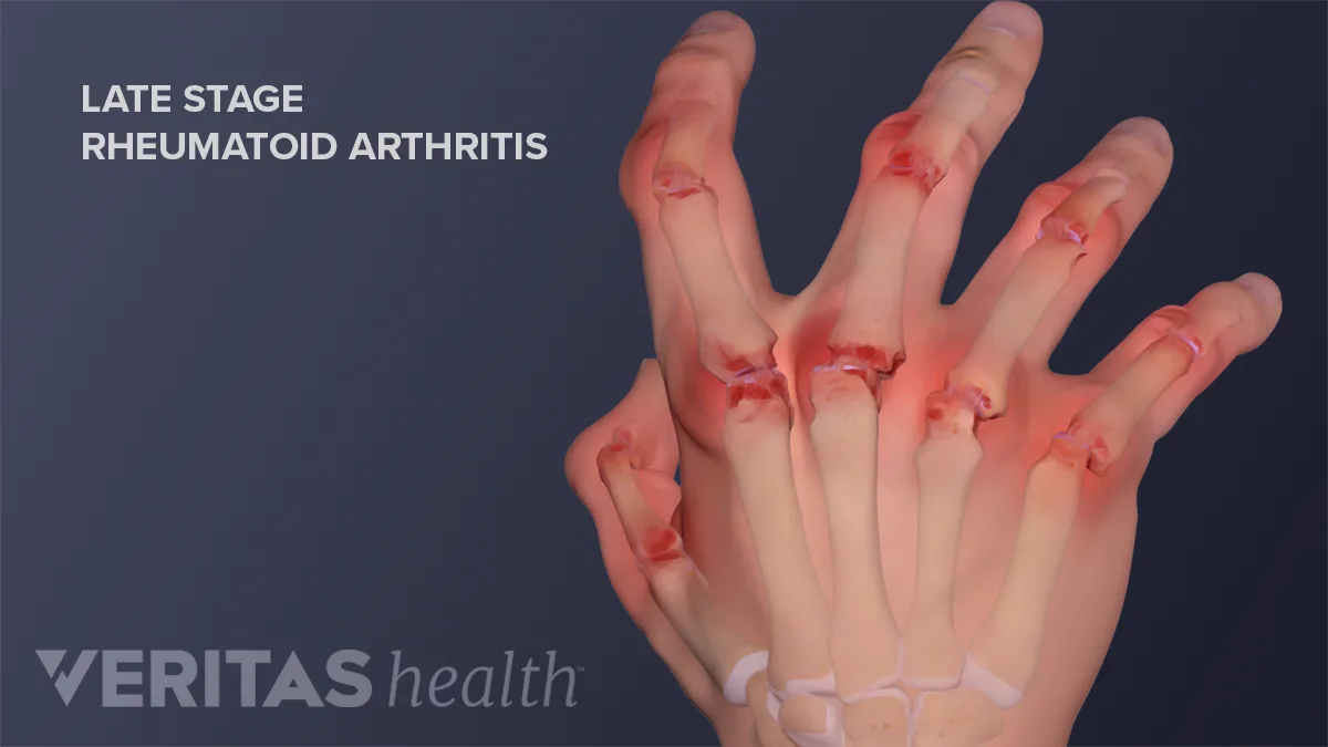 Treatments for Rheumatoid Arthritis in Hands