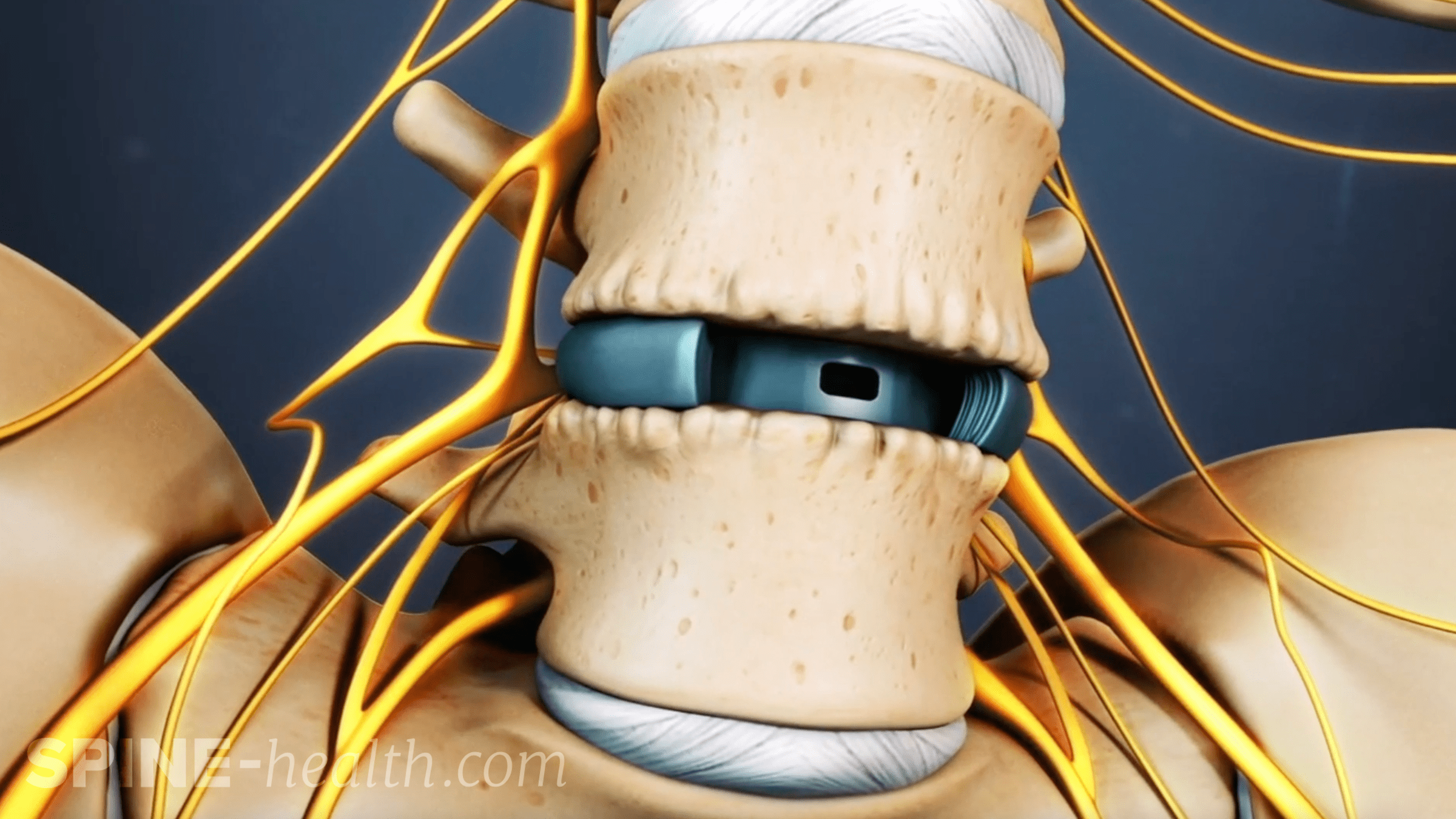 Lumbar Spinal Fusion Surgery Animation | Spine-health