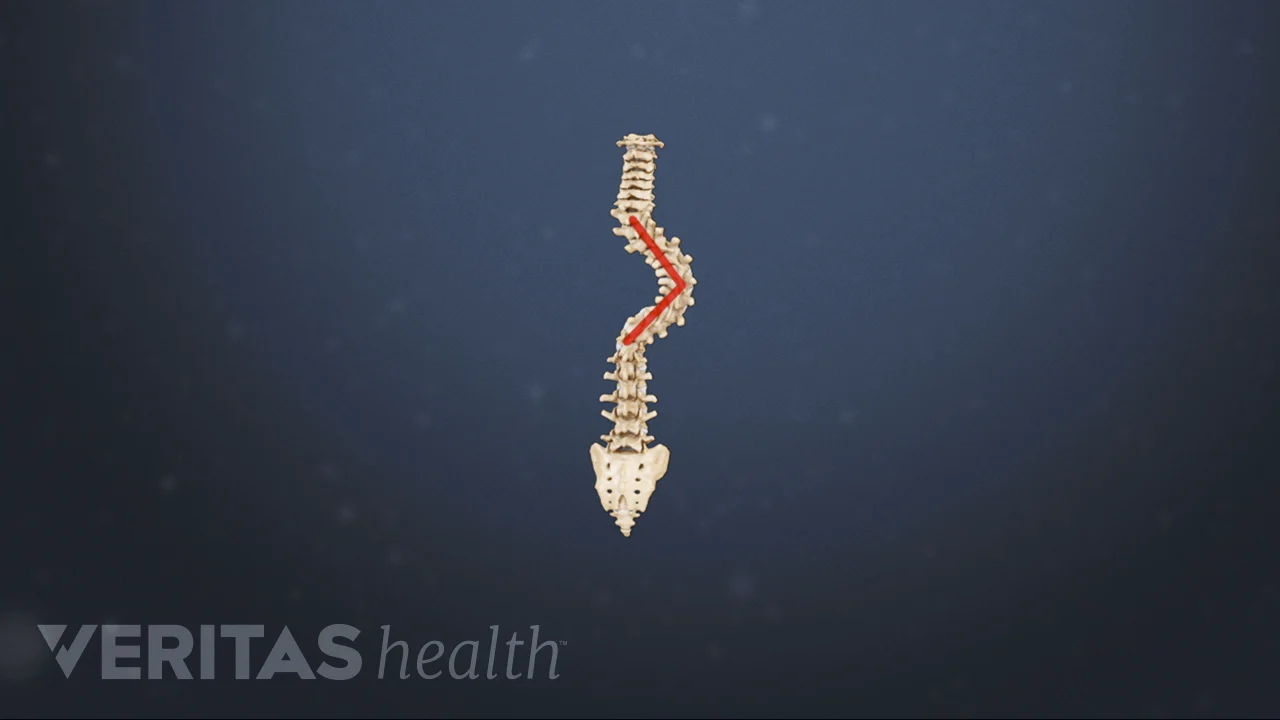 Cobb Angle Measurement and Treatment Guidelines | Spine-health