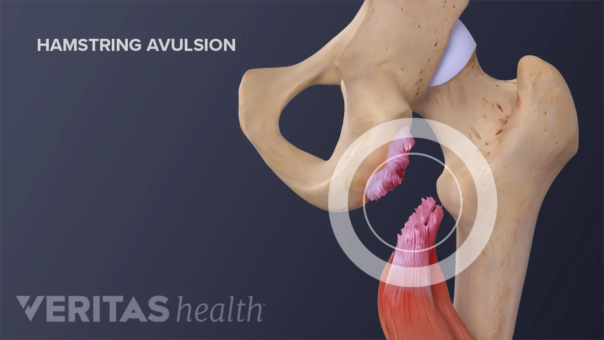 Hamstring Tears: Diagnosis | Sports-health