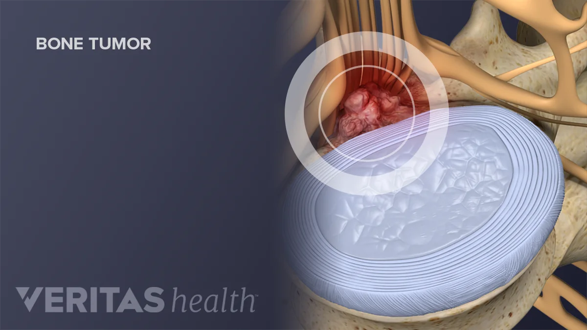 Types of Spinal Tumors | Spine-health