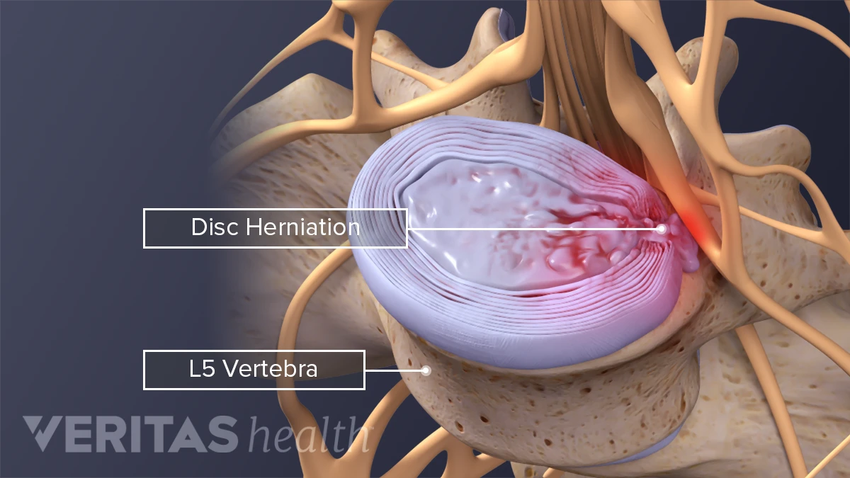 Lumbar Herniated Disc Symptoms | Spine-health