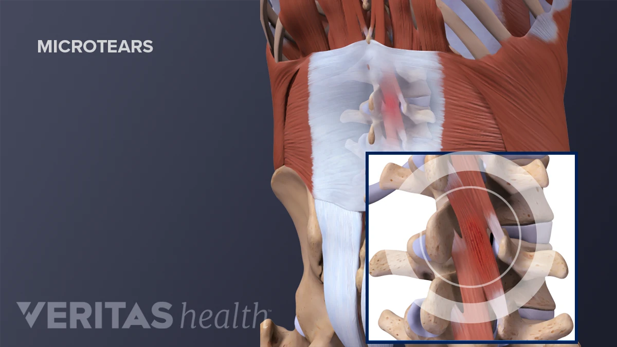 Causes and Diagnosis of Lower Back Strain | Spine-health
