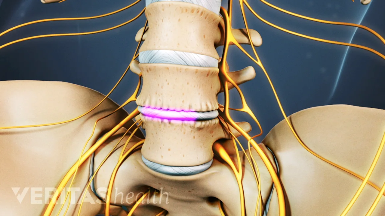 Potential Risks and Complications with ALIF Surgery | Spine-health