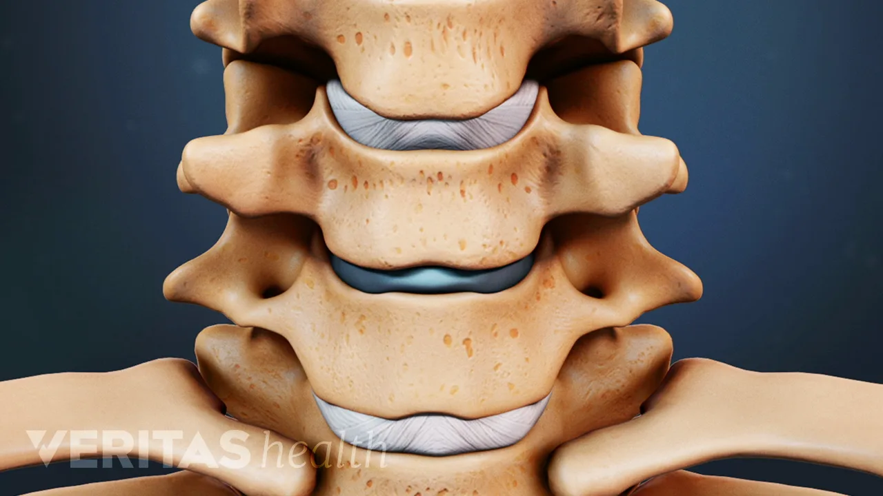 Comparison of 2-Level Cervical Artificial Disc vs. 2 Level ACDF | Spine ...