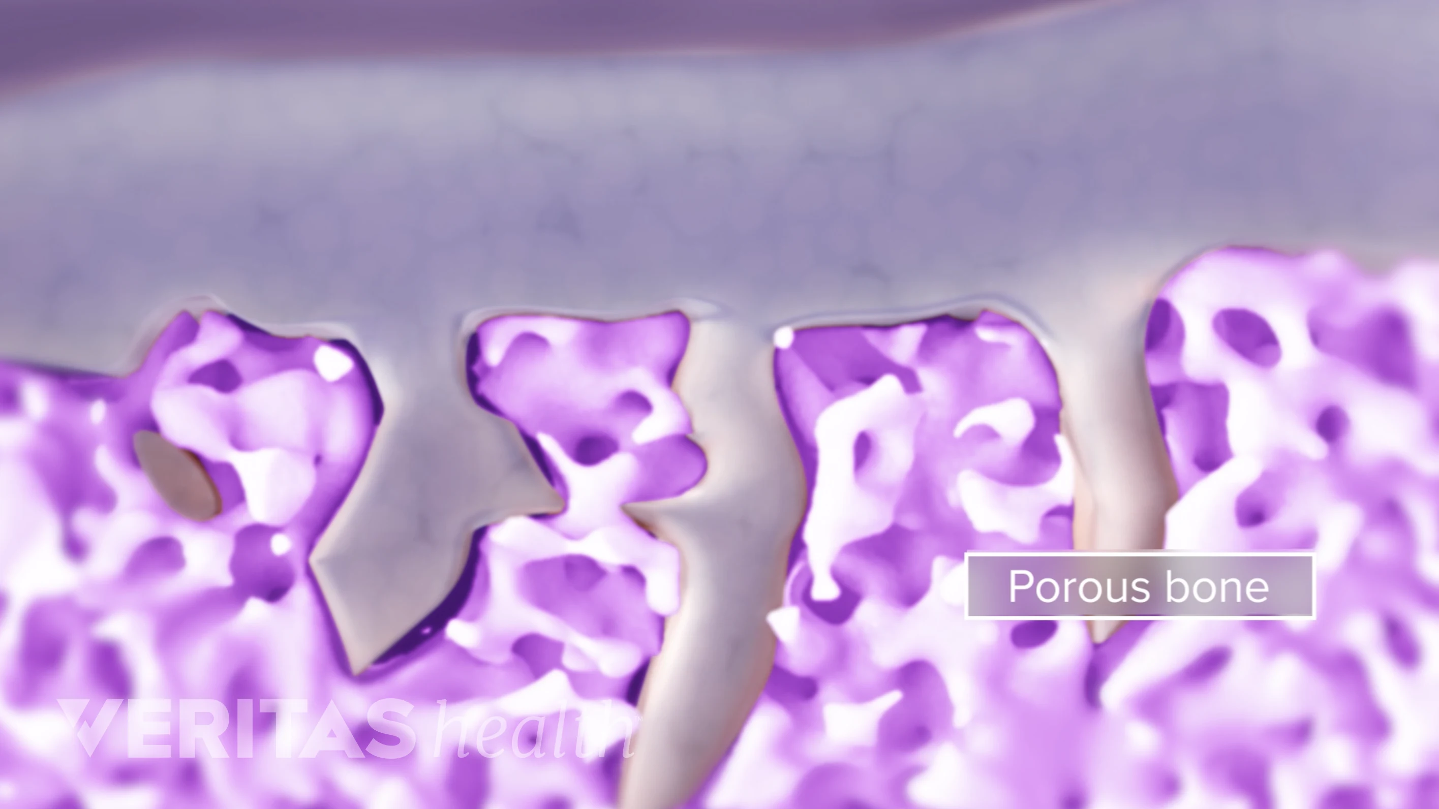 How to Increase Bone Density | Spine-health