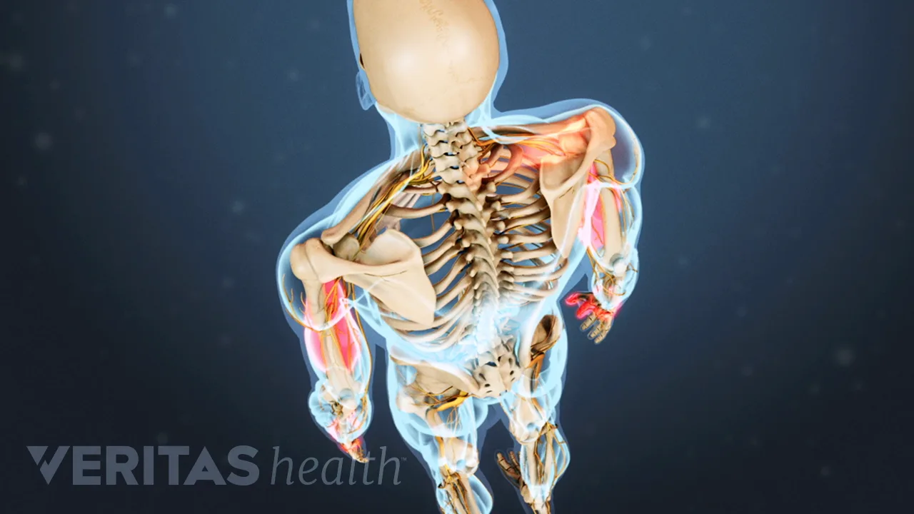 All About Neuropathy And Chronic Back Pain | Spine-health