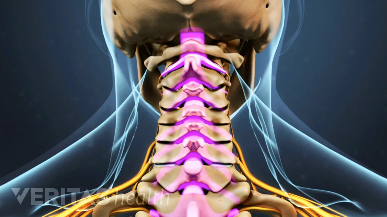 Cervical Foraminal Stenosis Causes and Diagnosis | Spine-health