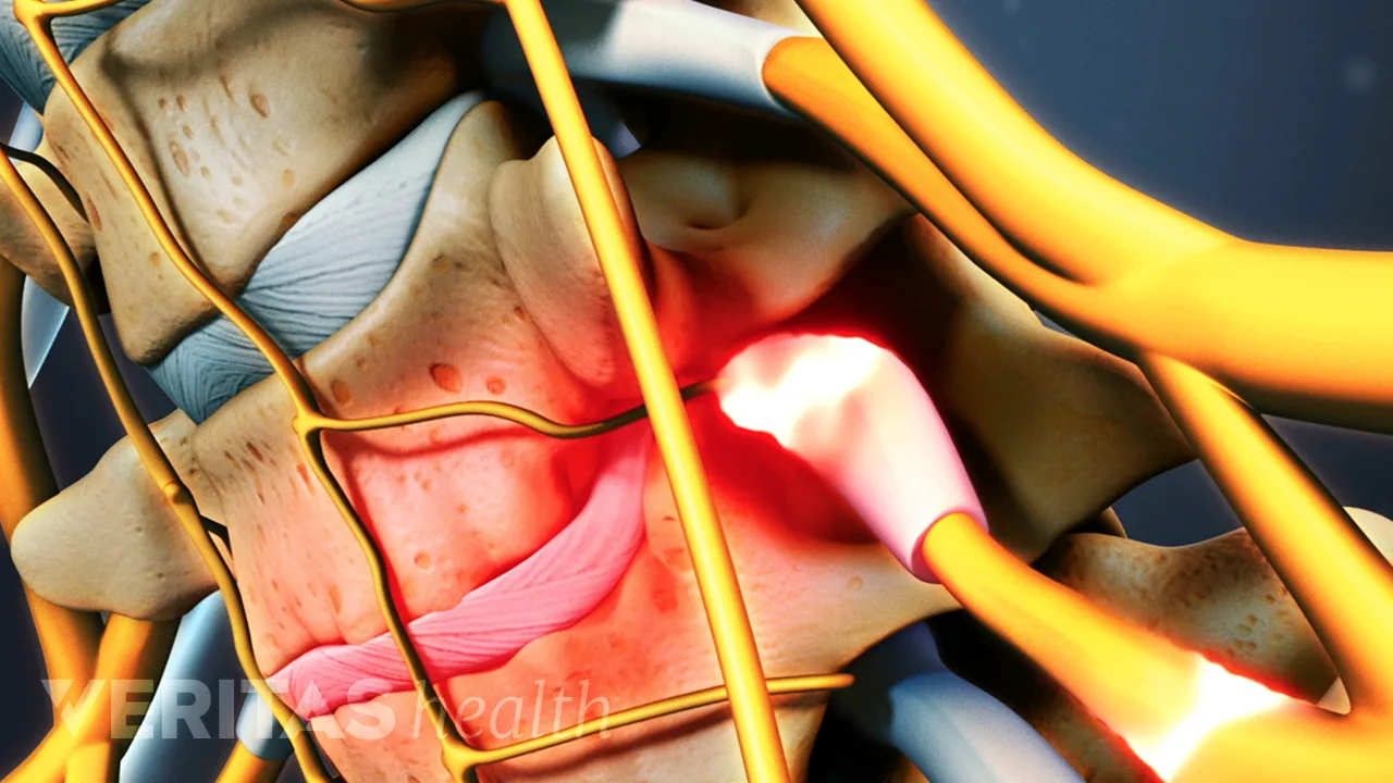 Cervical Selective Nerve Root Block Video Spine Health